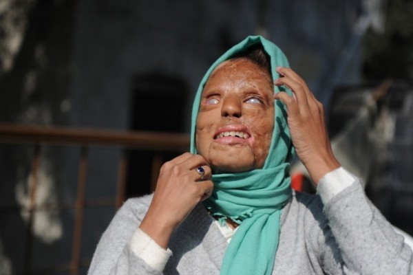 Burned With Acid For Spurning Sexual Advances | Youth Ki Awaaz